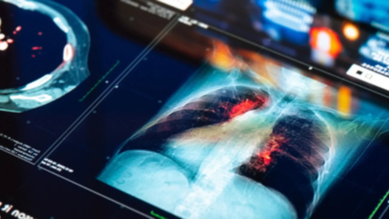 Why Lung Screening Matters - El Sol News Media